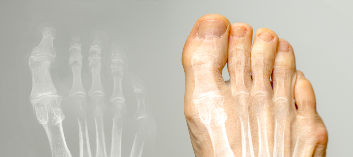 Hallux Rigidus - Freefoot